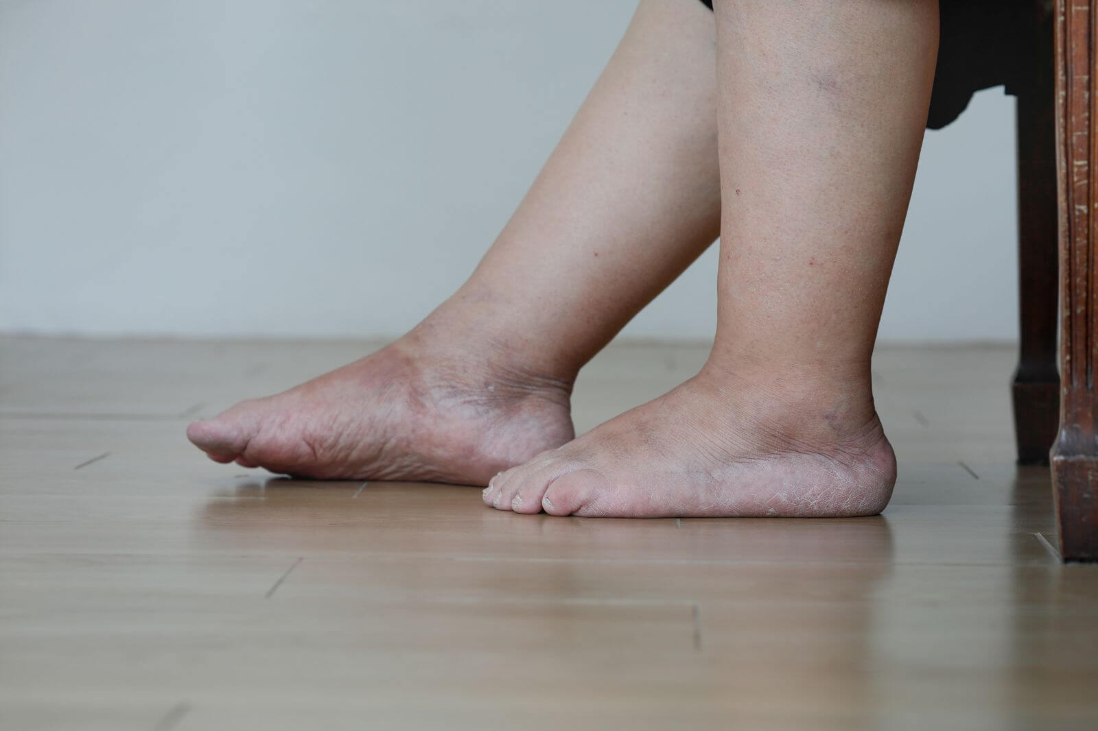 Swollen knees and ankles store
